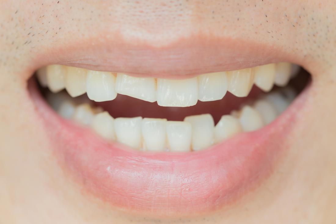 The Most Common Causes Of A Cracked Tooth And How To Treat It - Buzzy ...